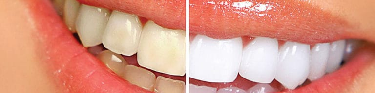 Teeth Whitening Fort Lauderdale & Broward County